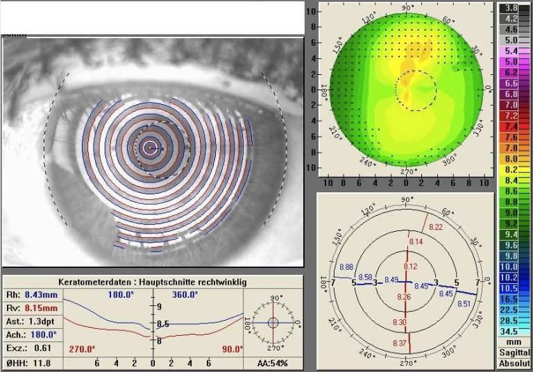 Astigmatismus (Hornhautverkrümmung) - Heiliger